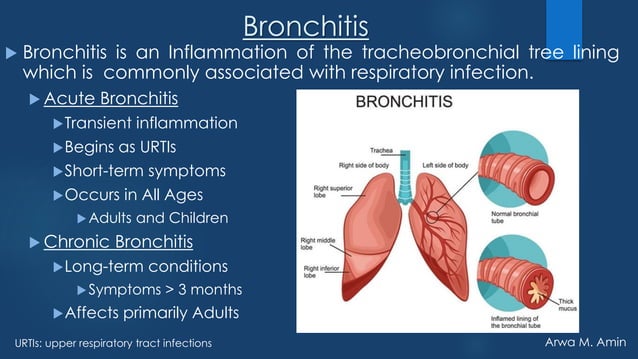 Bronchitis: An overview | PPT