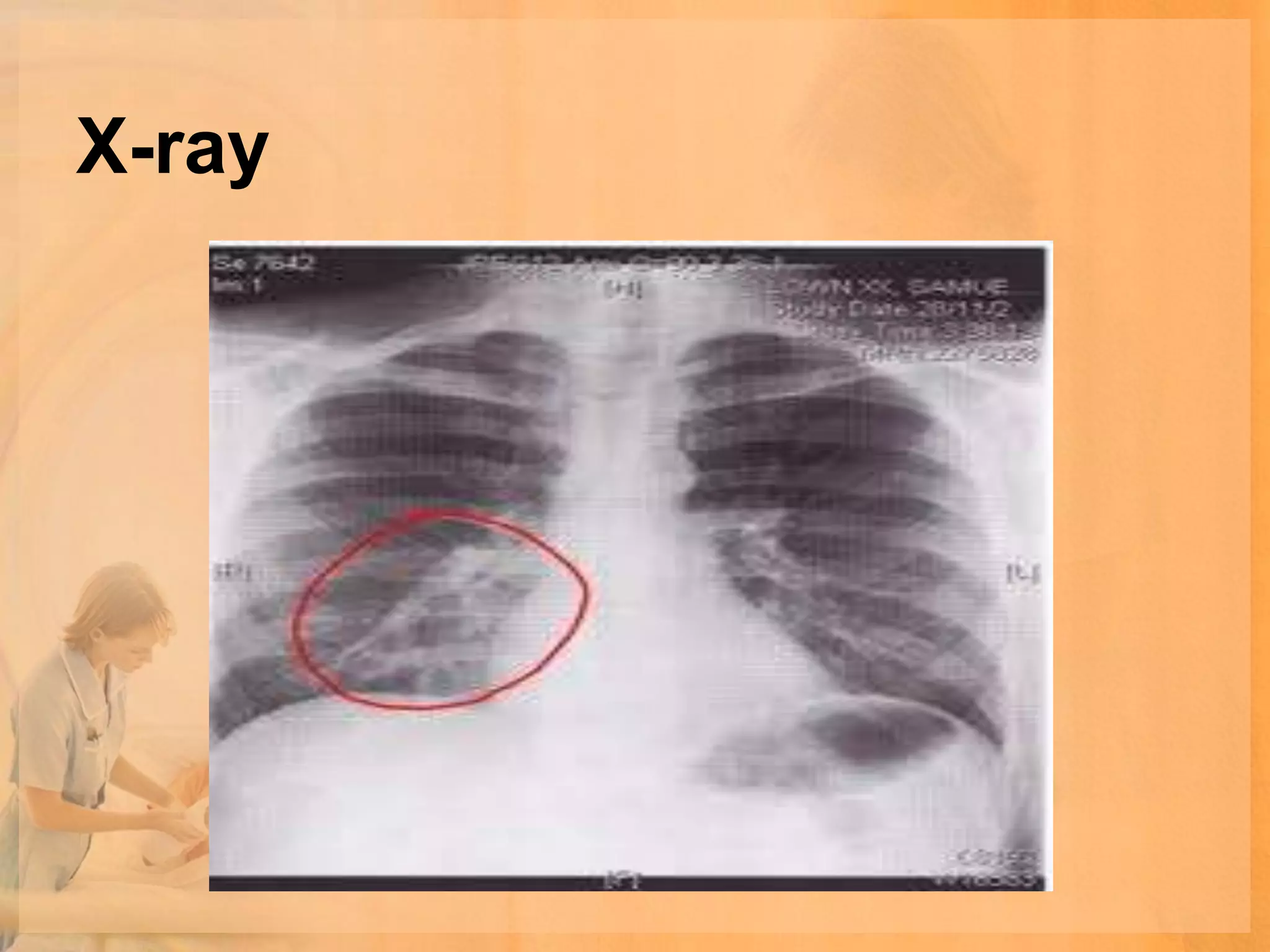 Lower Respiratory Tract Infections Ppt Pptx