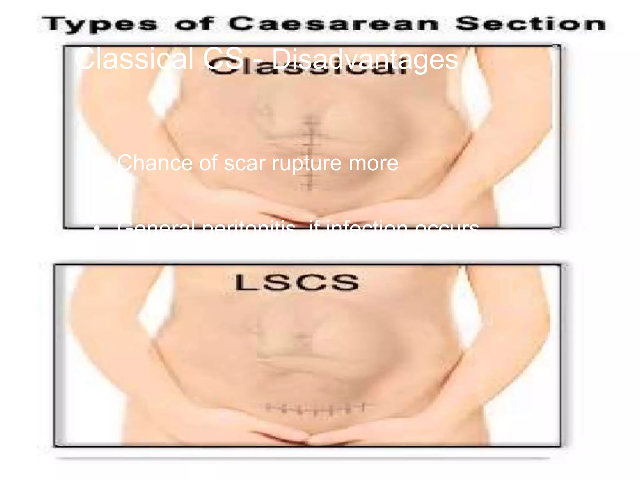 LOWER SEGMENT CAESAREAN SECTION.pptx