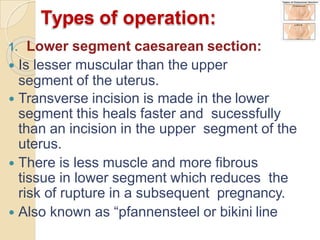 LOWER SEGMENT CAESAREAN SECTION.pptx
