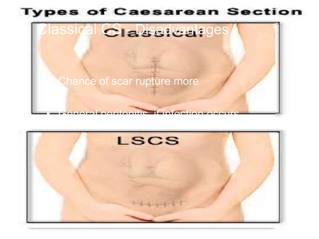 LOWER SEGMENT CAESAREAN SECTION.pptx