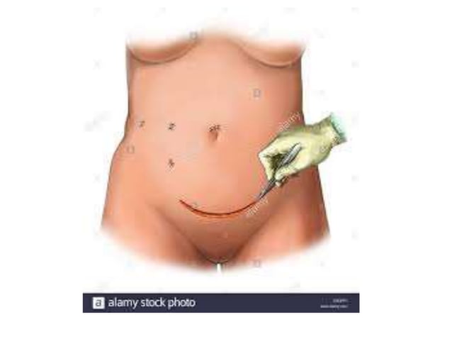Lower Segment Ceaserean Section Ppt