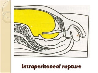 Lower urinary tract injuries | PPT