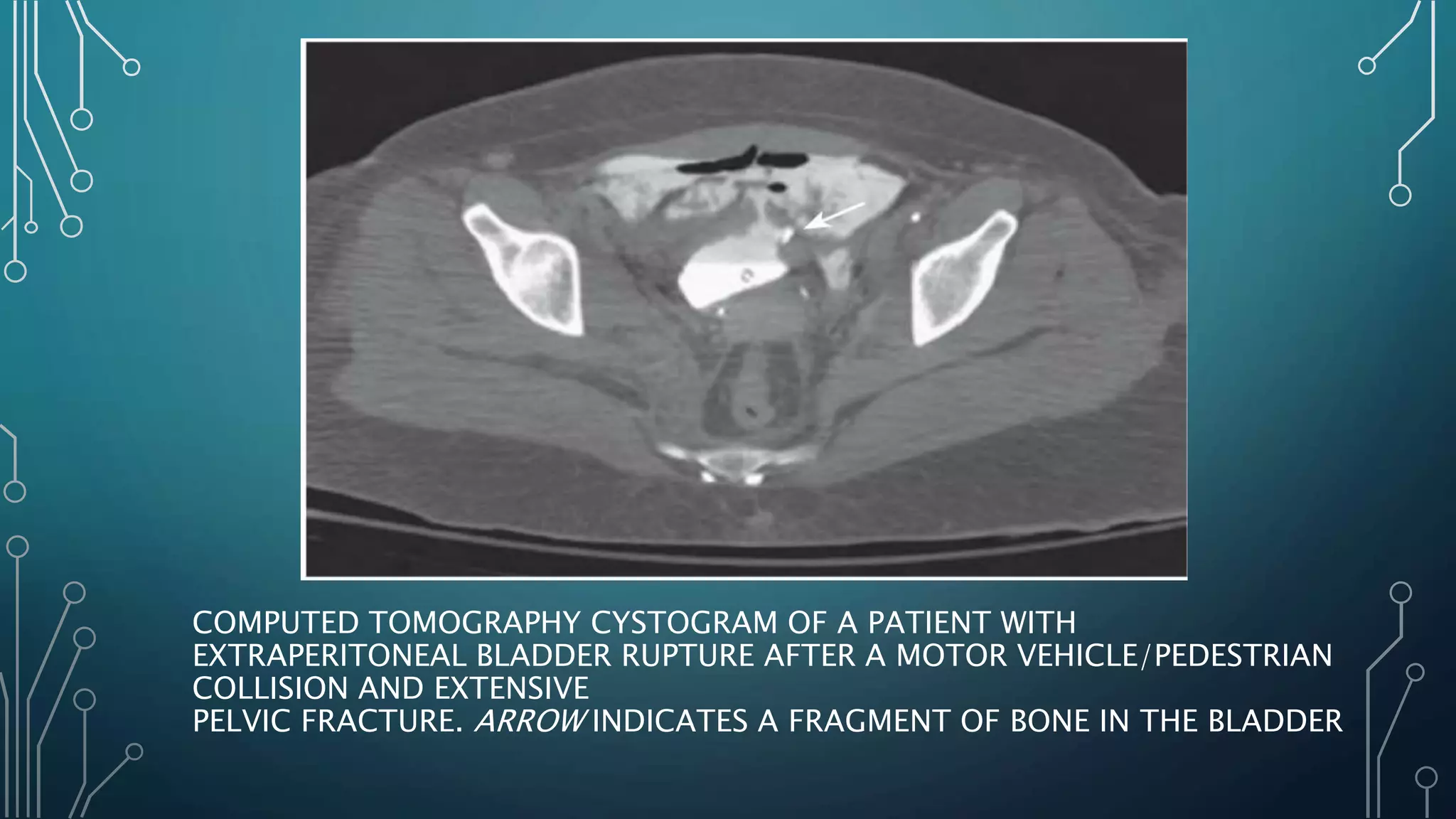 Lower urinary tract trauma | PPTX