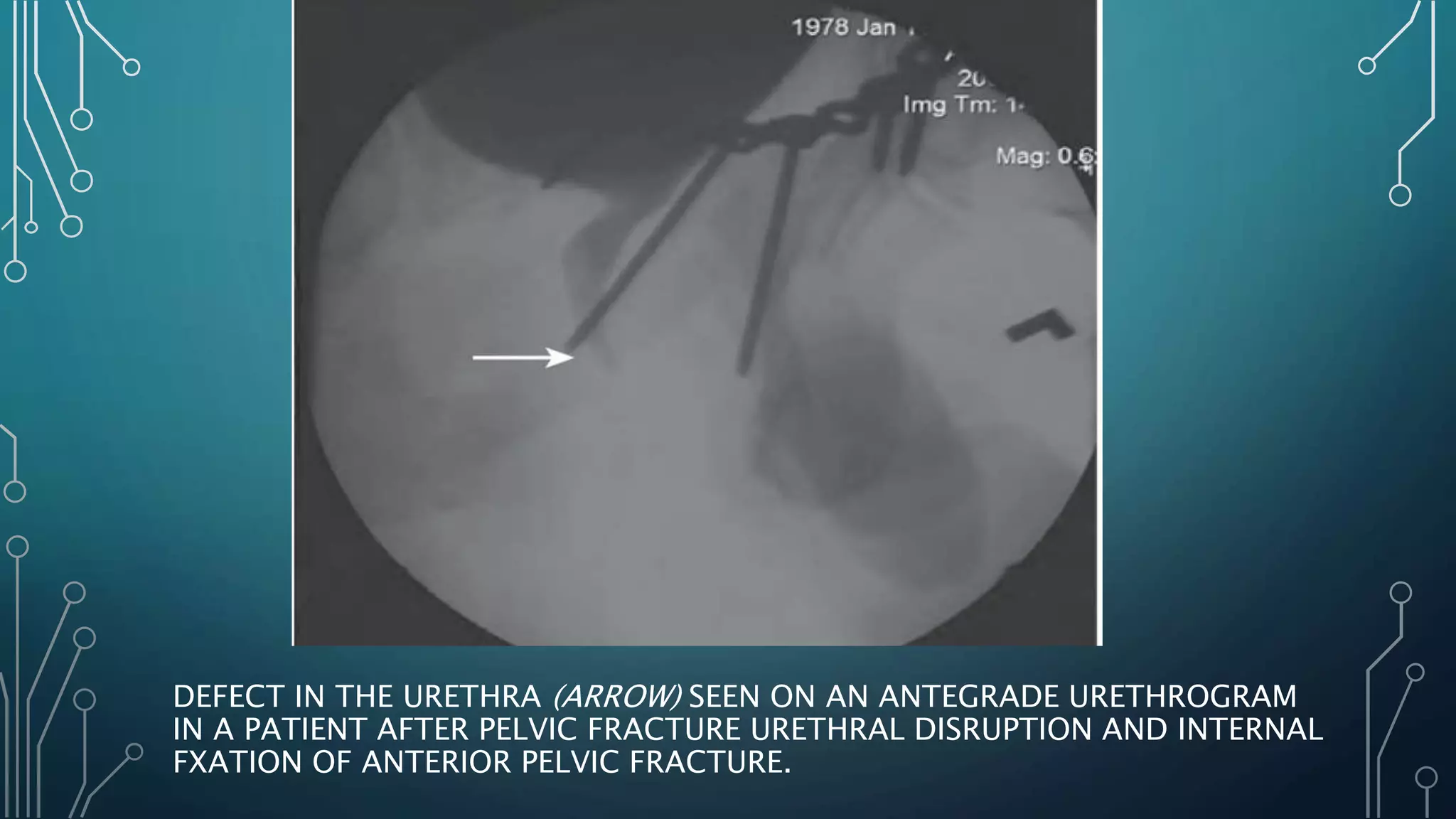 Lower urinary tract trauma | PPTX