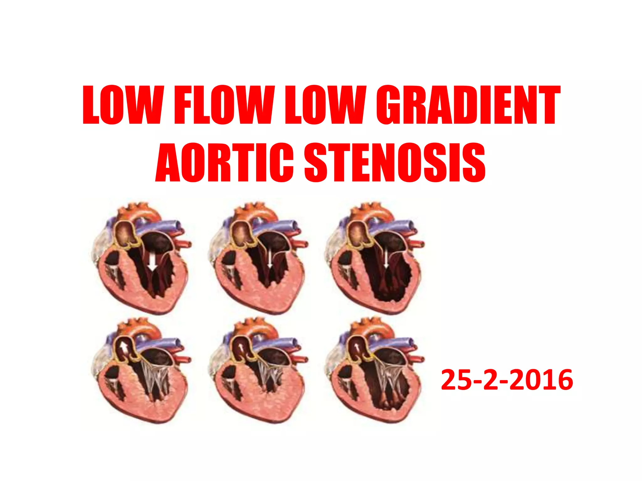 Low flow low gradient aortic stenosis | PPTX