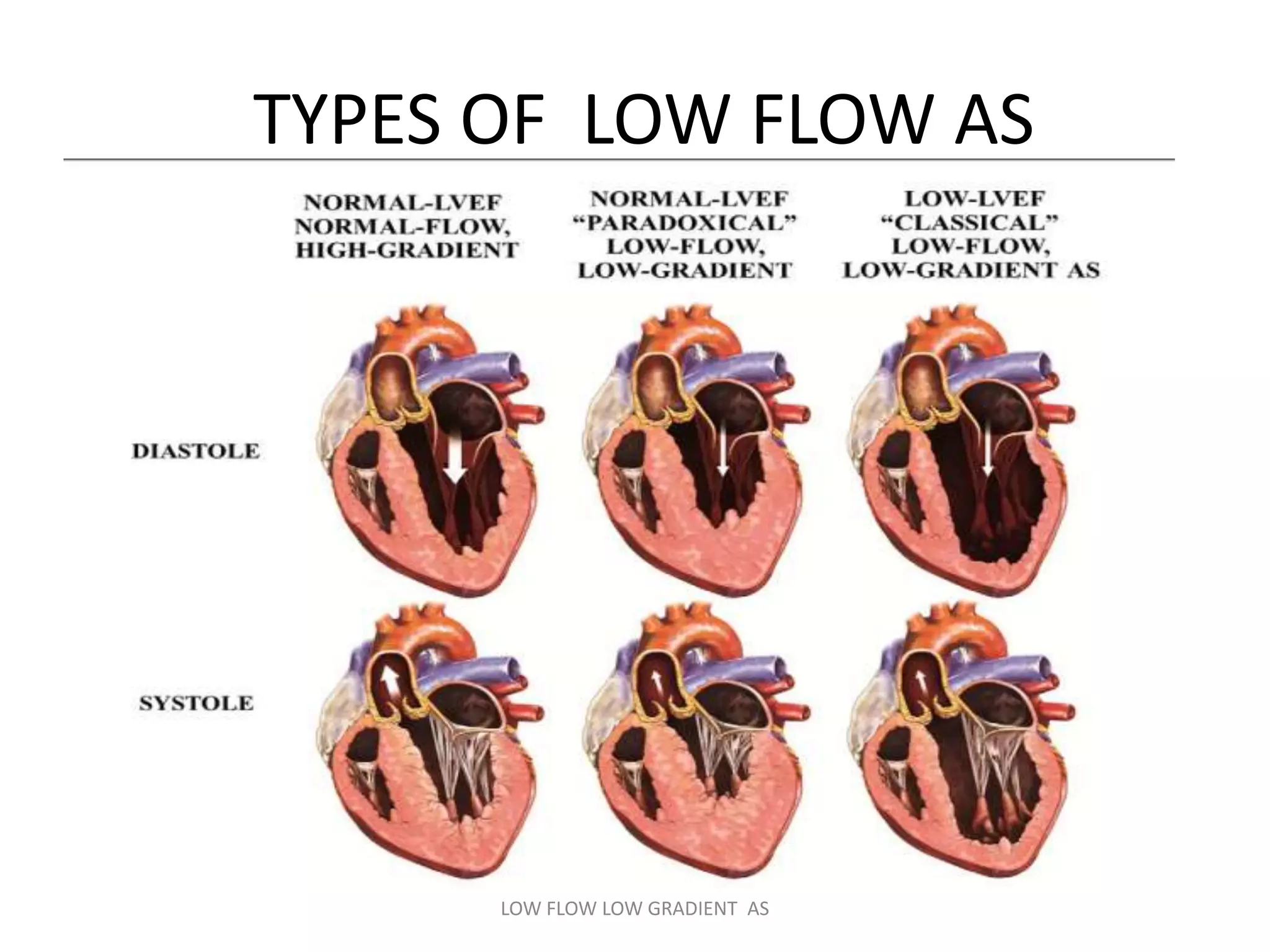 Low flow low gradient aortic stenosis | PPTX