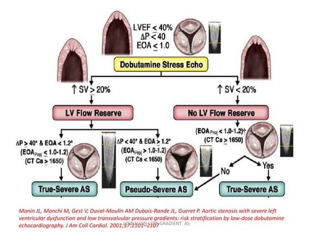 Low flow low gradient aortic stenosis | PPTX