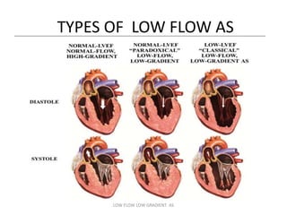 Low flow low gradient aortic stenosis | PPT