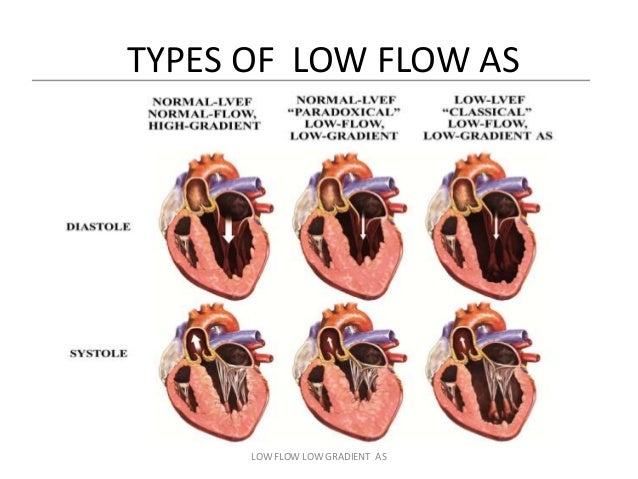 Low flow low gradient aortic stenosis