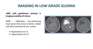 LOW GRADE GLIOMA management in radiotherapy | PPTX