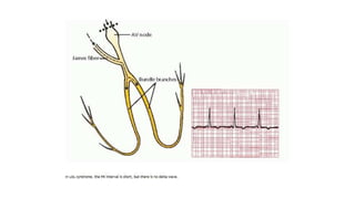 Lown ganong-levine syndrome | PPT