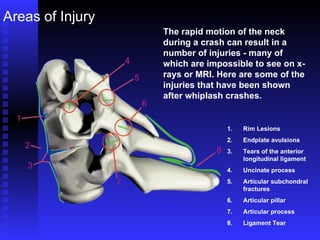 Low Speed Rear End Collisions | PPT