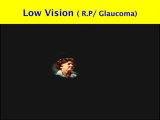 low vision intro and definitions, this PPT comprises, basic definitions ...