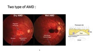 Low vision management of patient with AMD. | PPTX