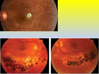 Low vision case Study Of Retintis Pigmentosa | PPTX