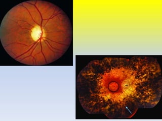 Low vision case Study Of Retintis Pigmentosa | PPTX