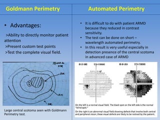 Low vision workup in ARMD | PPTX | Eye and Vision Conditions | Diseases ...