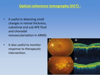 Low vision workup in ARMD | PPT