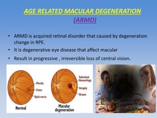 Low vision workup in ARMD | PPTX | Eye and Vision Conditions | Diseases ...