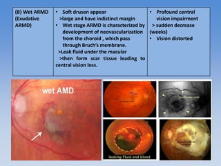 Low vision workup in ARMD | PPTX | Eye and Vision Conditions | Diseases ...