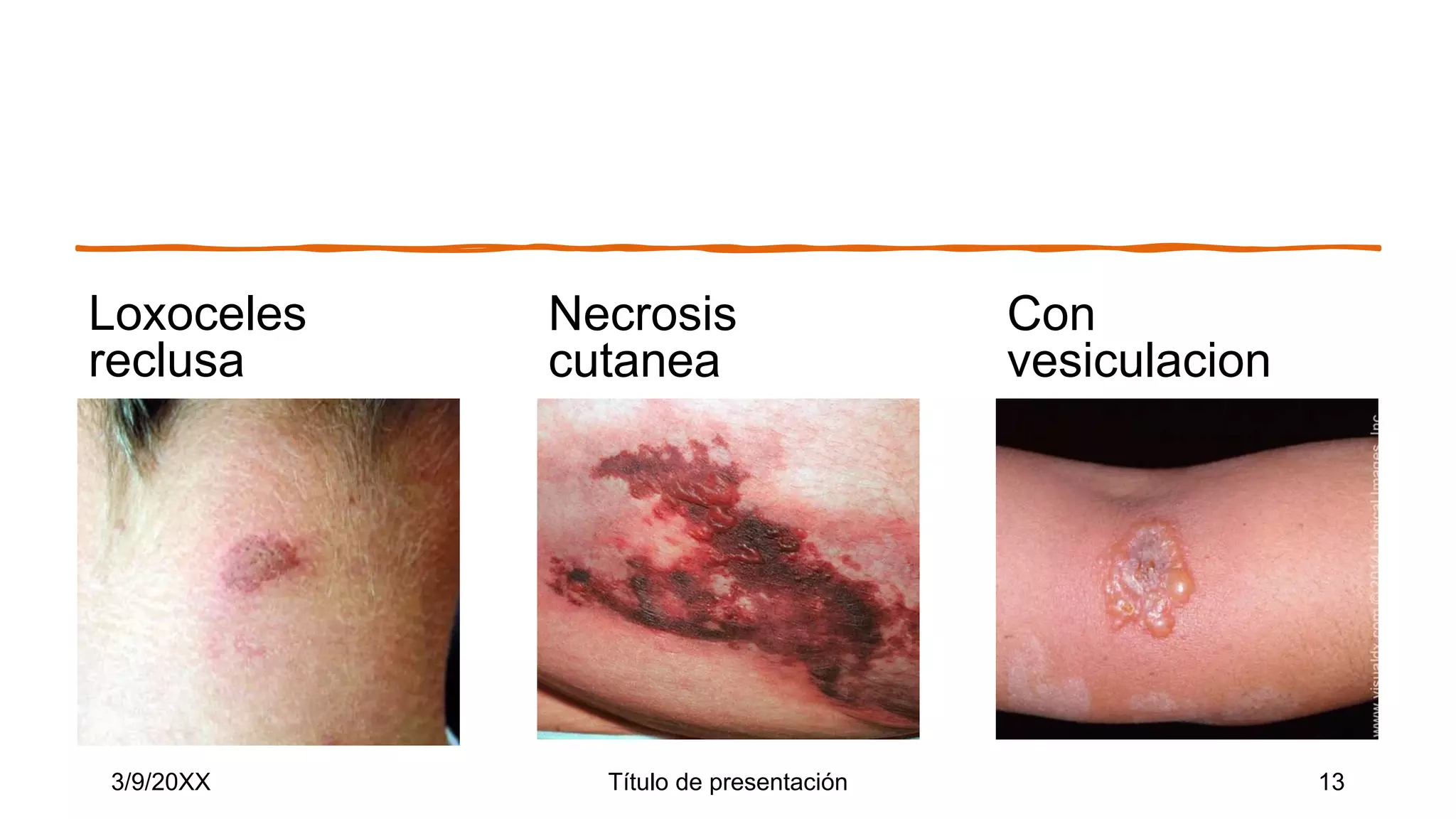 Loxoscelismo.pptx