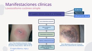 Intoxicacion por loxosceles. atencion en urgencias | PPT