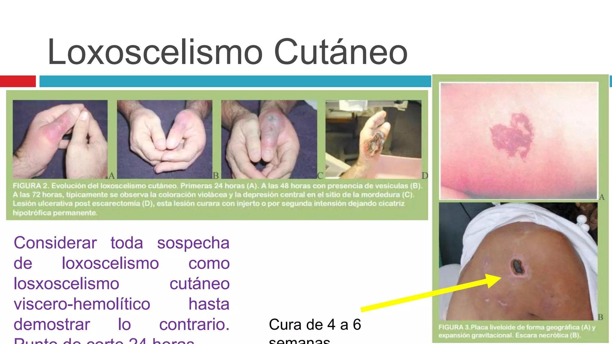Loxoscelismo y ofidismo en pediatria | PPTX