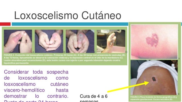 Loxoscelismo y ofidismo en pediatria