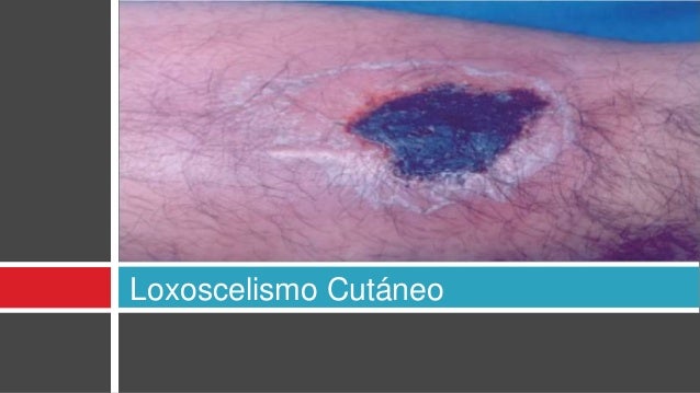 Loxoscelismo y ofidismo en pediatria