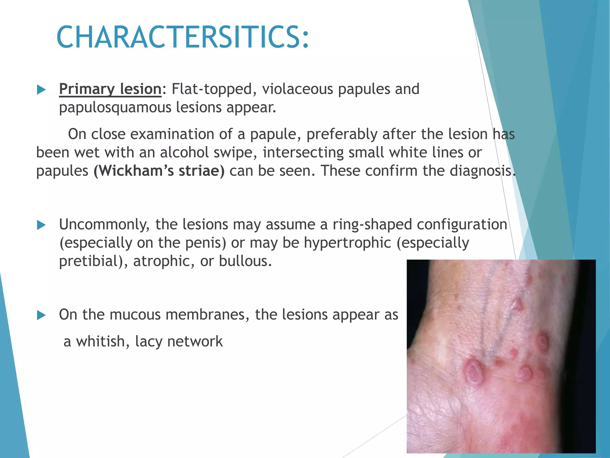 Lichen planus | PPTX