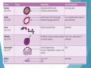 Lichen Planus Histology Civatte Body
