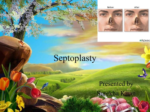 nursing care of Septoplasty | PPT