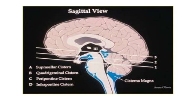 Lumbar puncture and CSF Analysis | PPTX