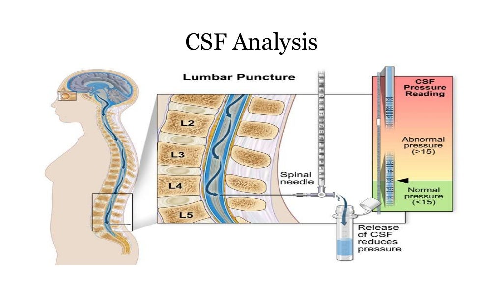 Lumbar puncture and CSF Analysis