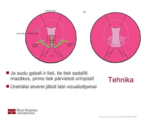 Labdabīga prostatas hiperplāzija. HoLEP | PPT