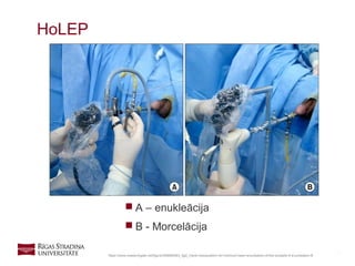 Labdabīga prostatas hiperplāzija. HoLEP | PPT