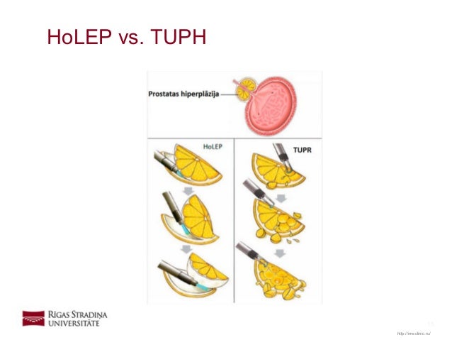 Labdabīga prostatas hiperplāzija. HoLEP