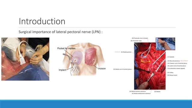 Journal club presentation of lateral pectoral nerve | PPTX