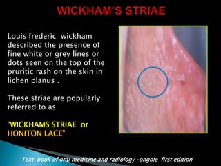 oral lichen planus presentation | PPT