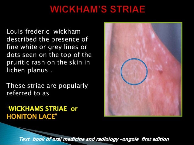 oral lichen planus presentation