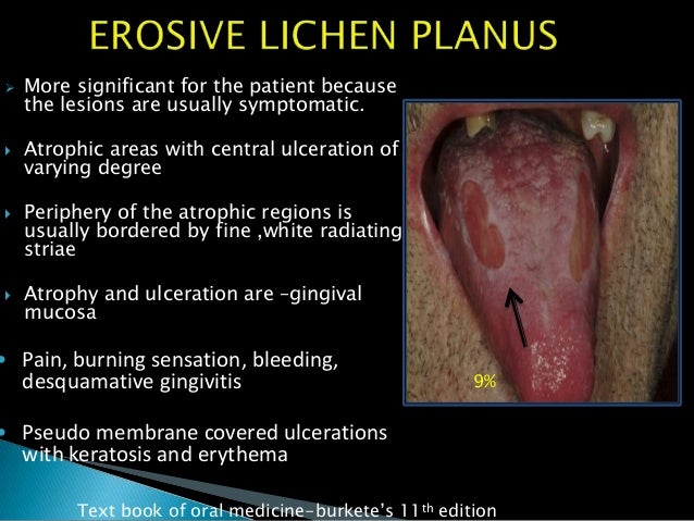 oral lichen planus presentation