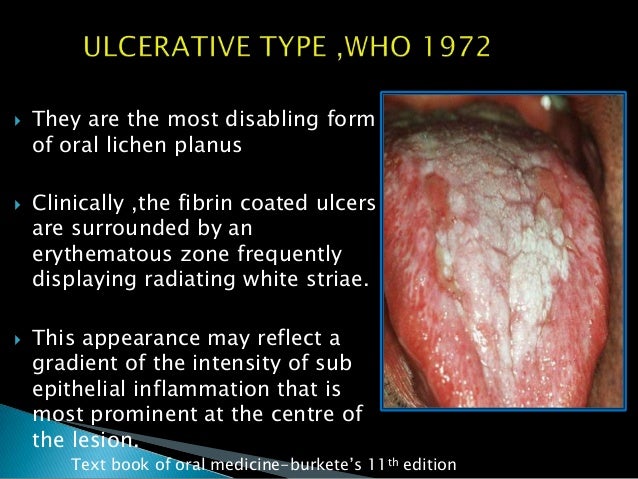 Oral Lichen Planus
