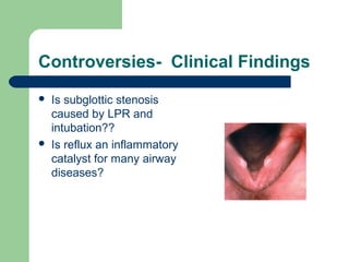 Laryngopharyngeal Reflux | PPT