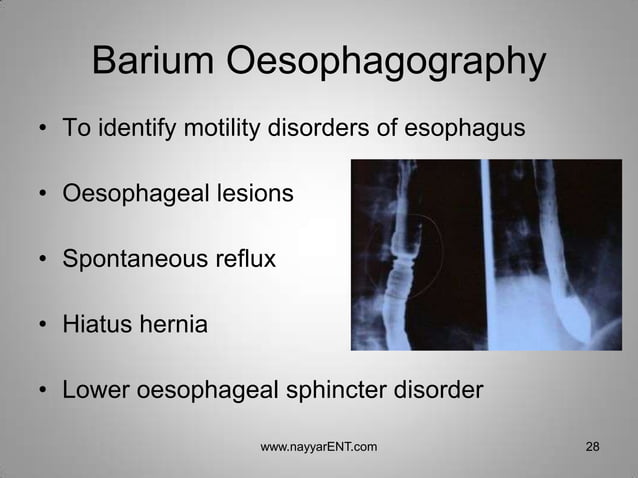 LPR Laryngopharyngeal Reflux | PPTX