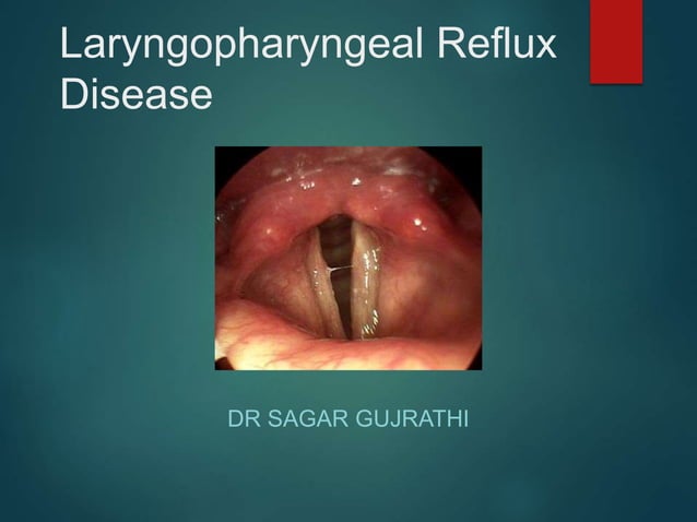 Laryngopharyngeal reflux disease (LPRD) by Dr Sagar Gujrathi.ppt