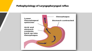 Clinical evaluation of Laryngopharyngeal reflux and its response to ...