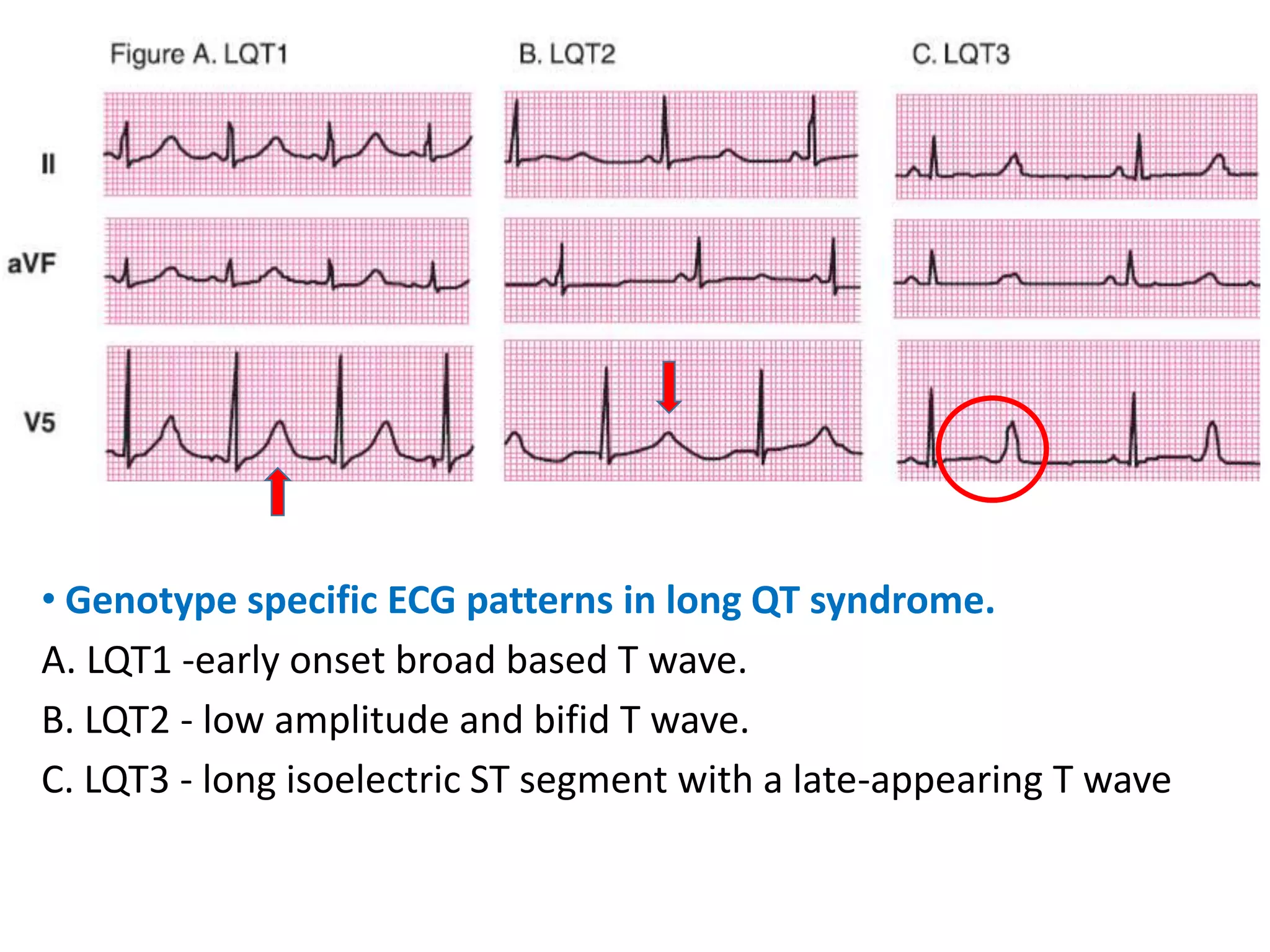 Long QT Syndrome | PPTX