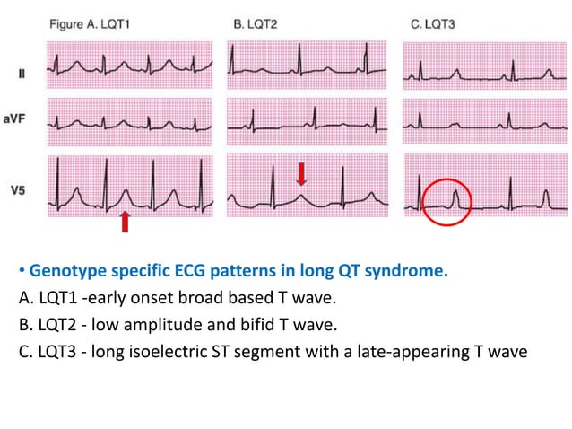 Long QT Syndrome | PPTX | Heart and Cardiovascular Diseases | Diseases and Conditions