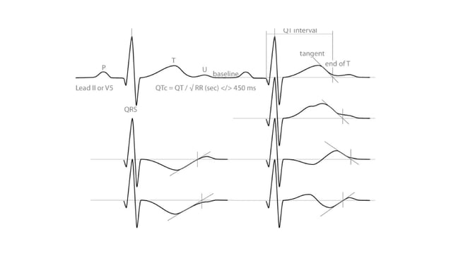 LQT syndrome, genetc basis powerpoint.pptx